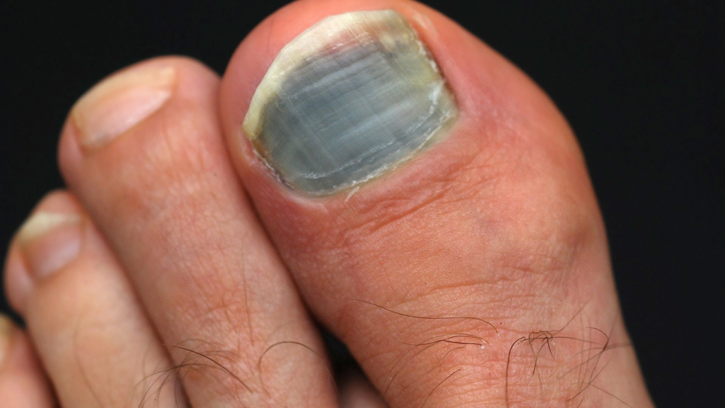 Do You Have A Dead Toenail? - Podiatry HQ Clinics