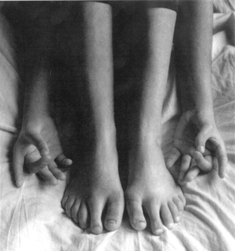 -POLYDACTYLY - How Common Are Extra Digits? - Podiatry HQ